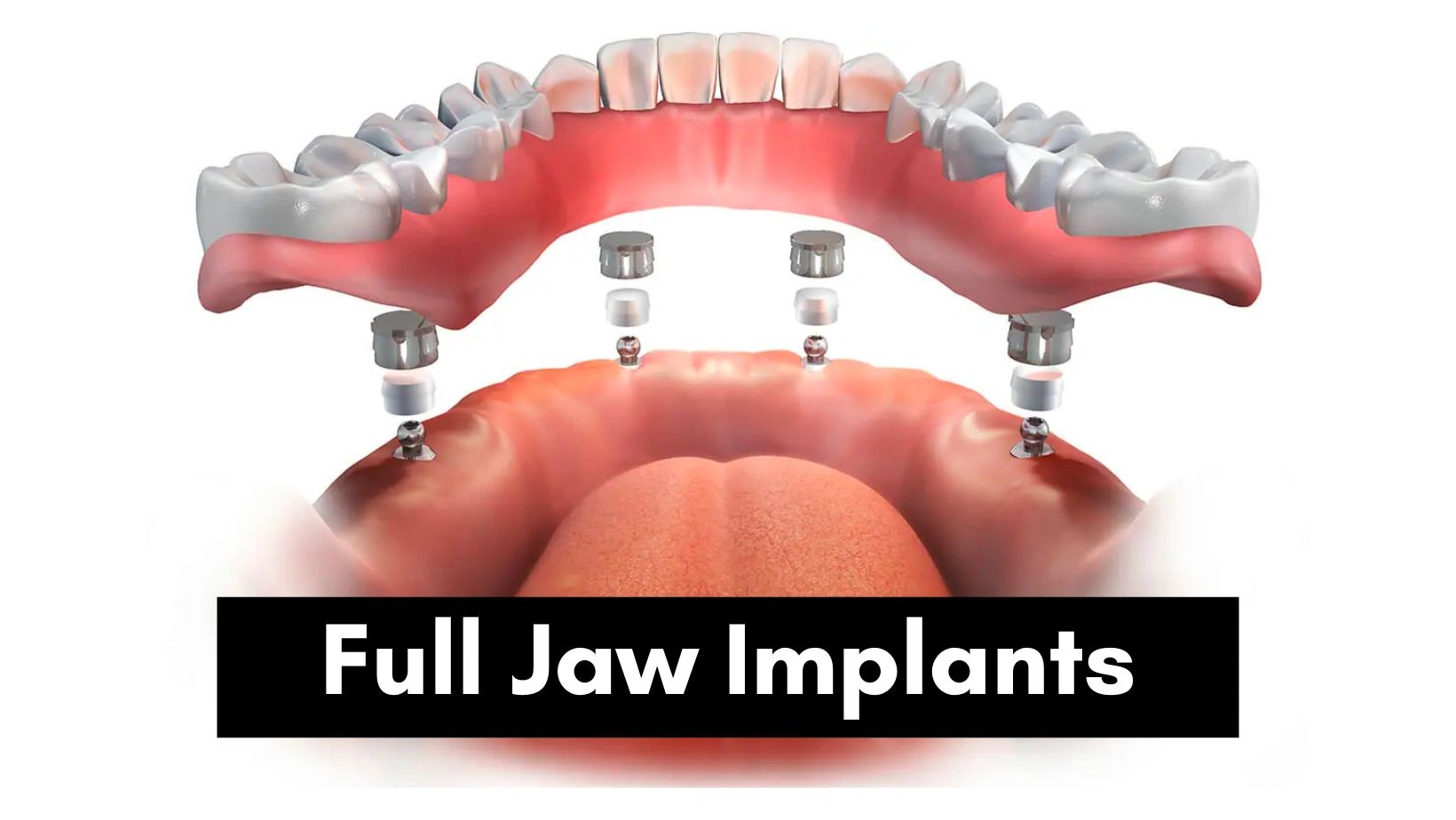 Full Jaw Implants 2494